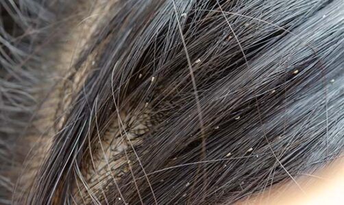 Treating Head Lice and Contagious Infections - Urgent Care Near Me ...