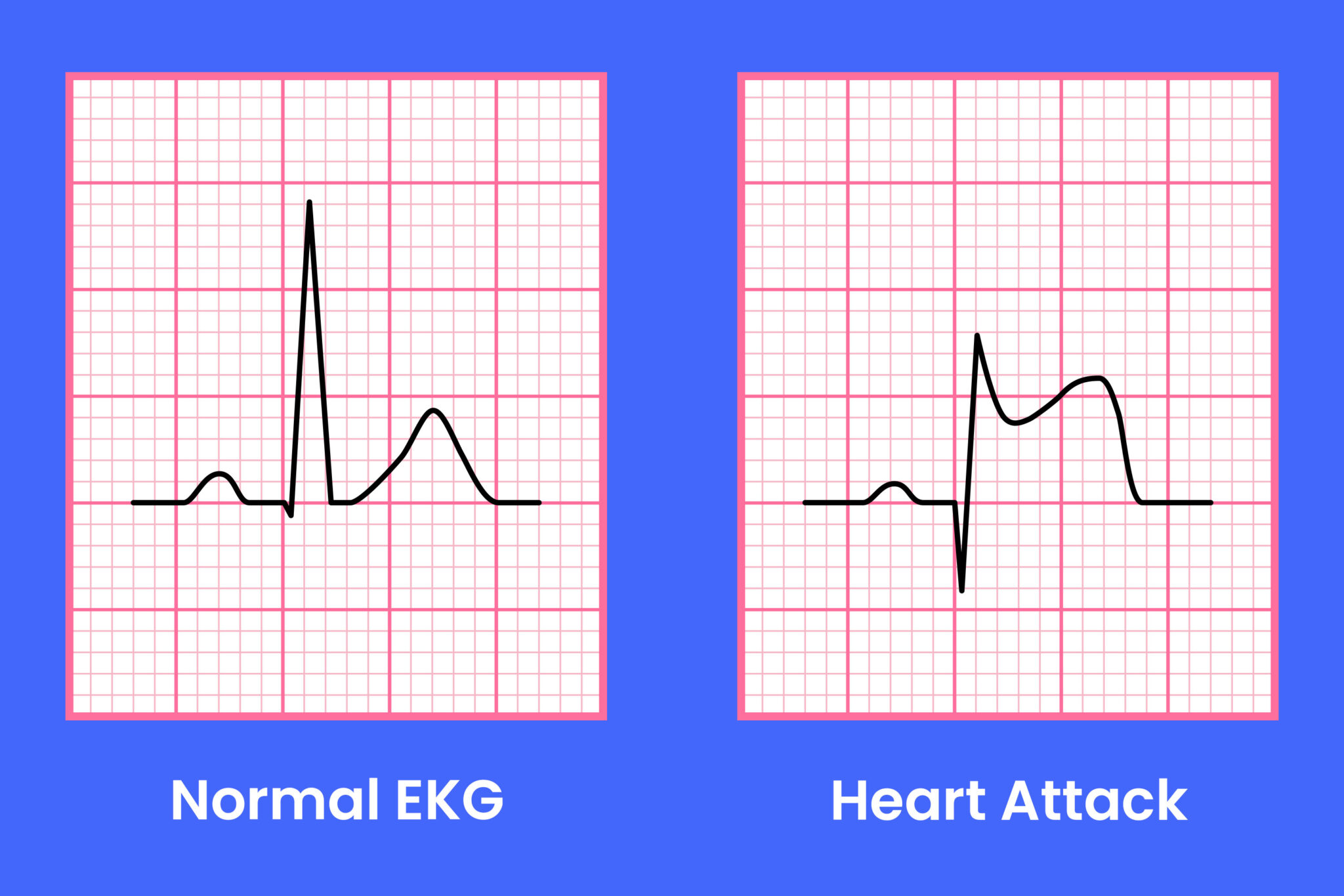 Understanding Your EKG Report: What the Results Mean