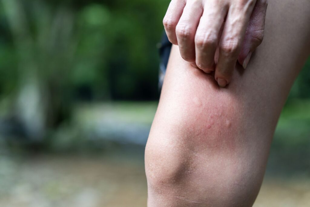 Managing Bug Bite Blisters: Why Not to Pop and What to Do Instead