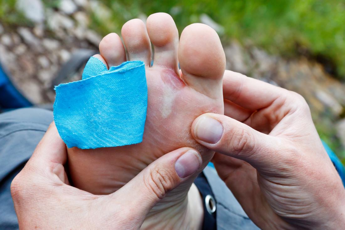 How to Safely Treat a Bug Bite Blister Without Popping It